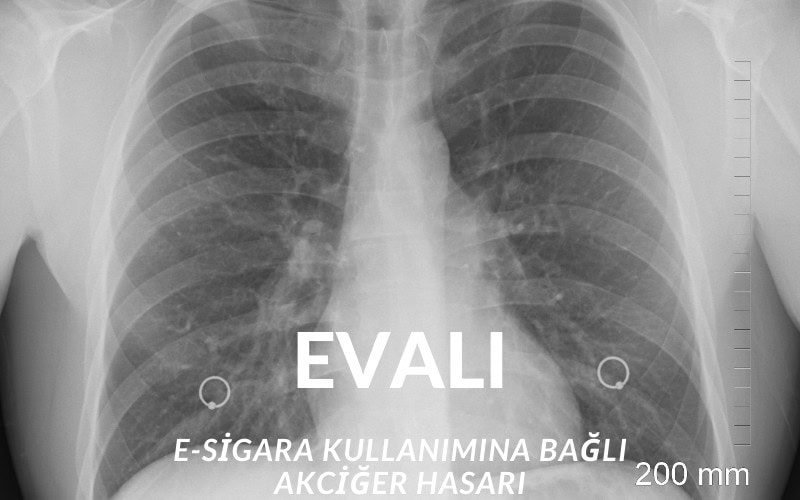 Evali Hastalığı Nedir? Evali Belirtileri Nelerdir? Elektronik Sigaraya ...